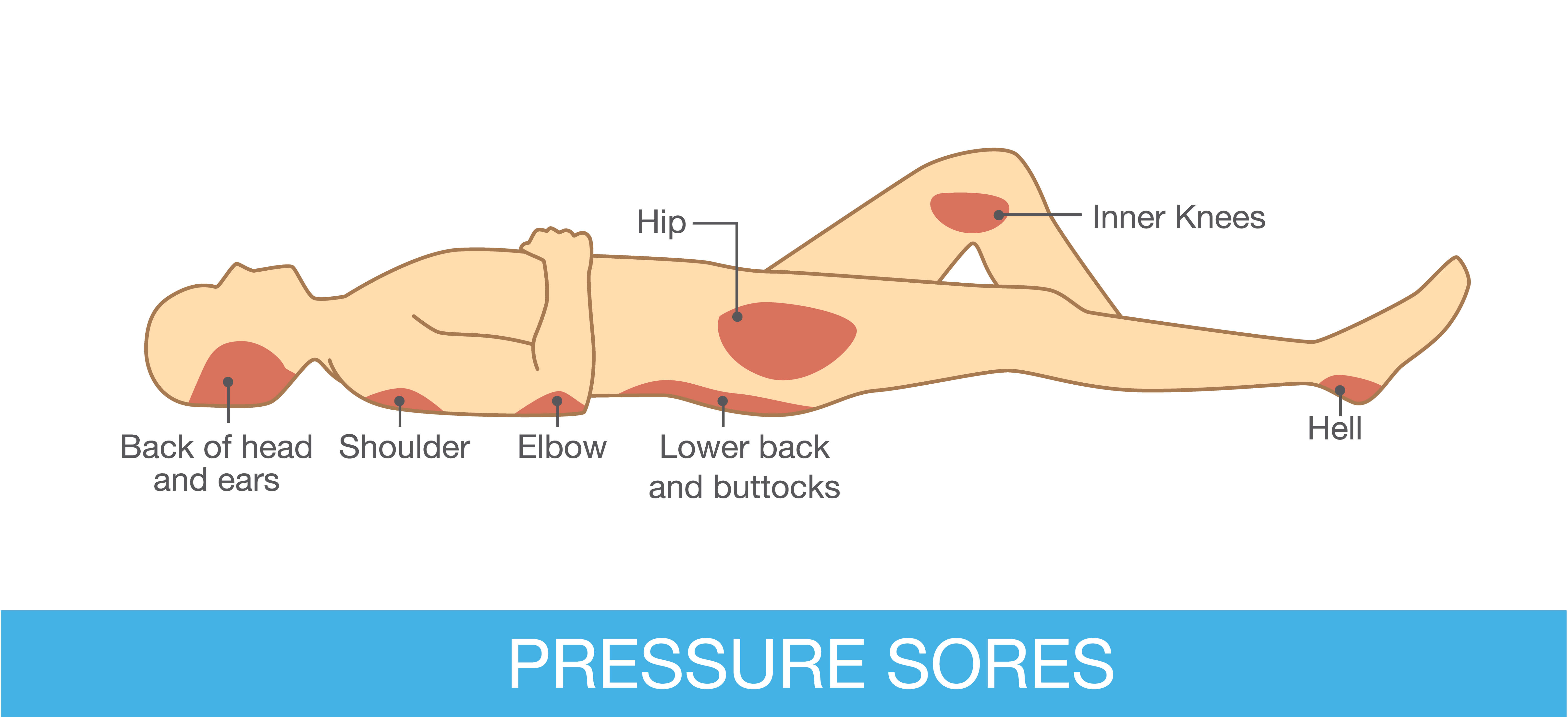 The Stages of Pressure Injuries: Identification and Management for Care ...